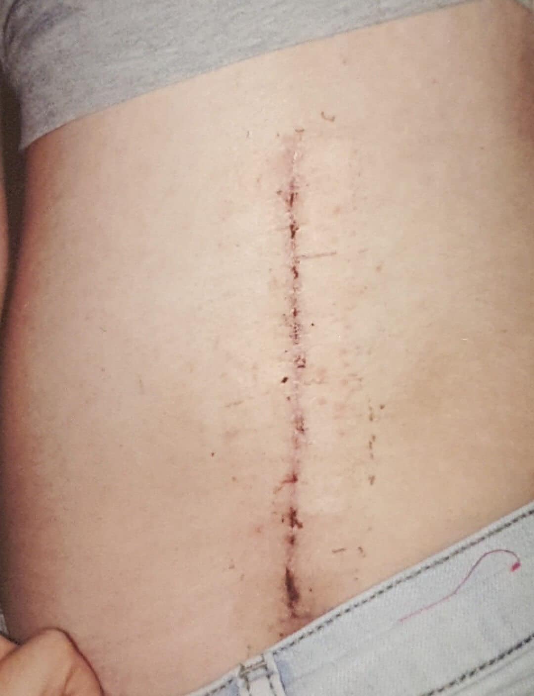 How I Knew I had a Spinal Tumour | Leah's Story | Children with Cancer UK
